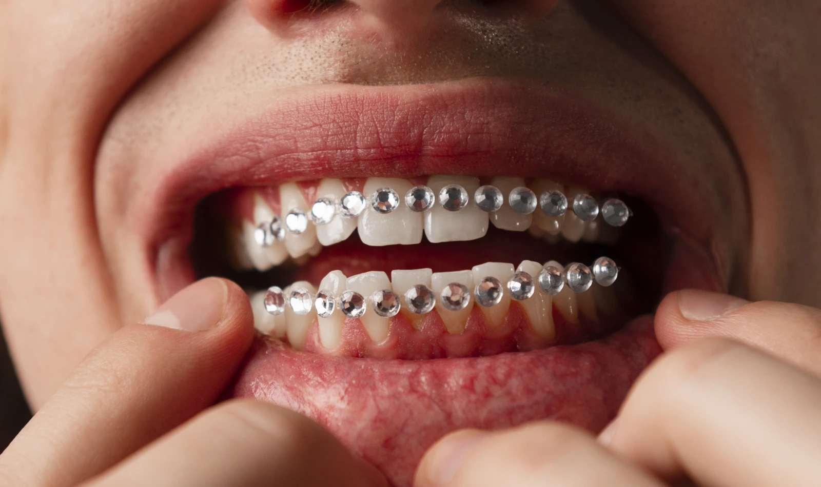 Misaligned Teeth - Teeth Empire Dental Clinic